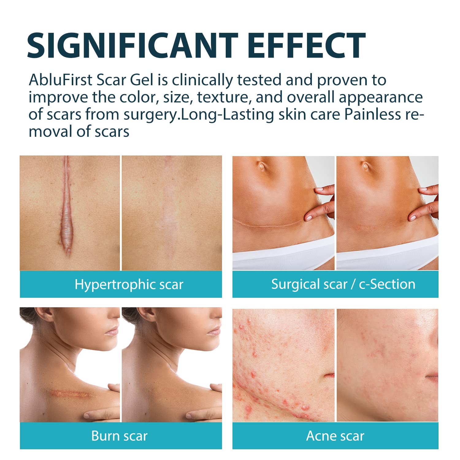 Silicone Scar Sheets(1.6“ × 120“Roll-3M), Medical Silicone Scar Tape ...