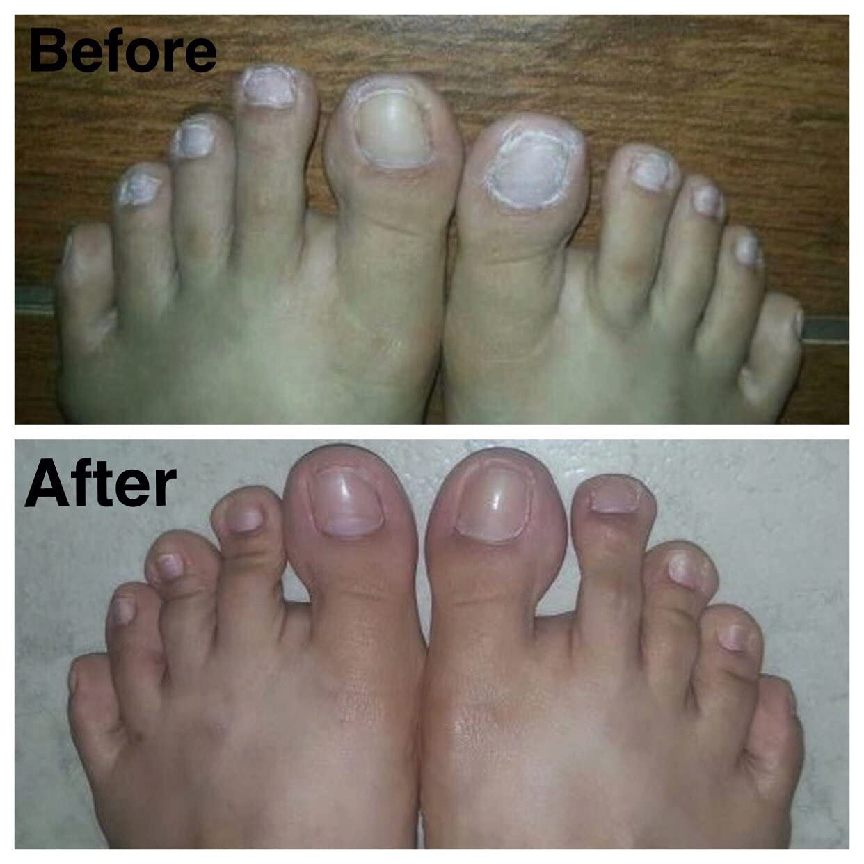 Probelle Extra Strength Natural Nail Fungus Treatment - Clinically ...