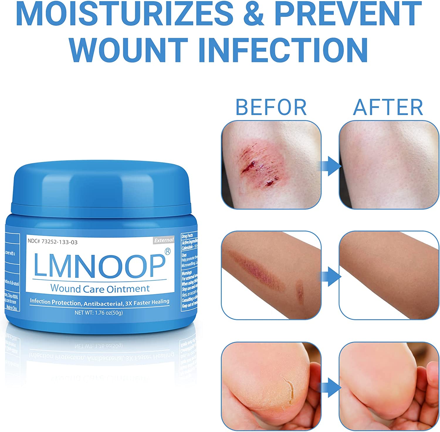 LMNOOP Wound Care Ointment: Pain Relief, Anti-Infection, Anti ...